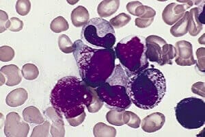 Faggot_cell_in_acute promyelocytic leukemia-MEDLEM-project - Elveflow